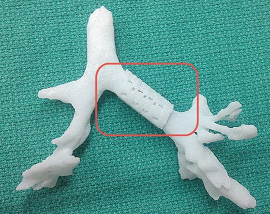 3d-printed-trachea | DiarioAbiertoDiarioAbierto